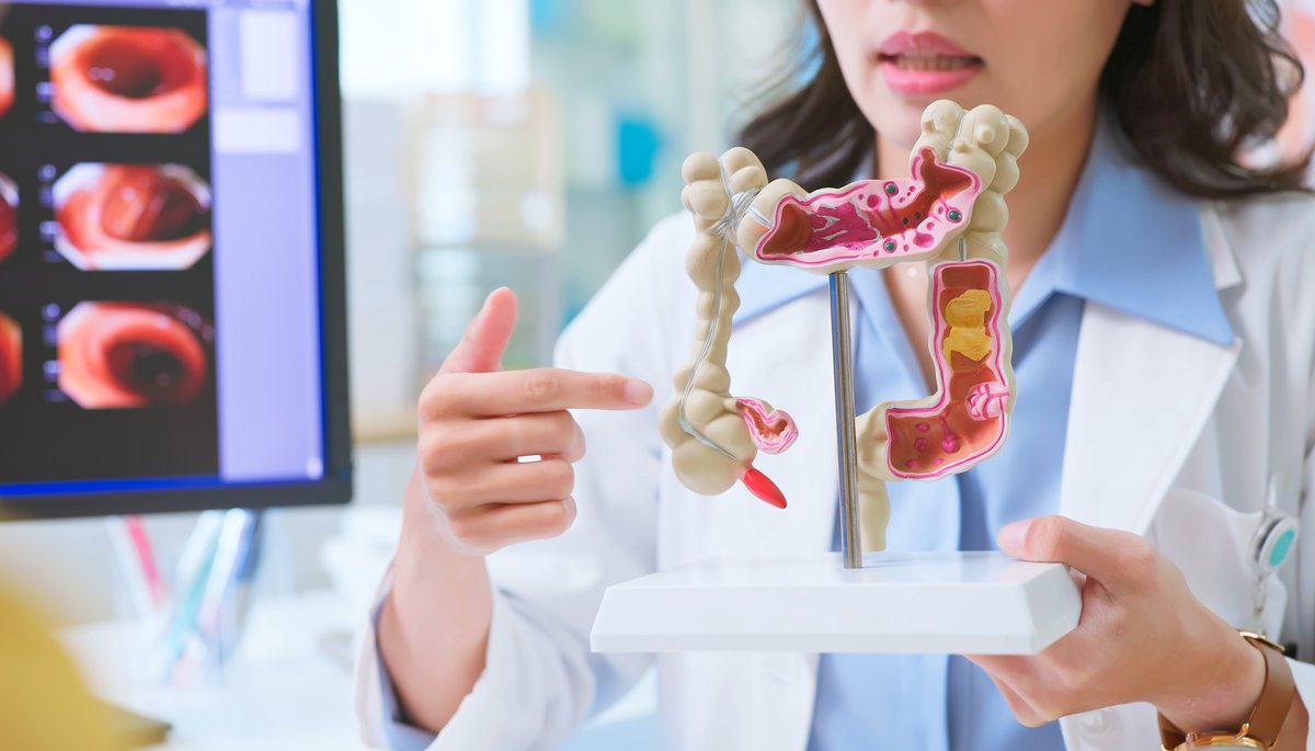 ¿Qué son los pólipos colónicos y por qué deberías revisarte a tiempo ...